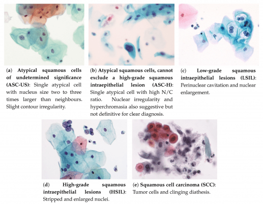 Screening - DeflaGyn®